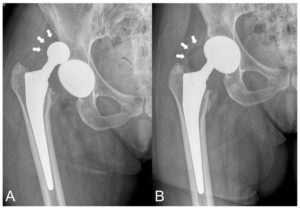 【2024年版】BHA・THAの手術・脱臼肢位・リハビリテーション・自主トレまで解説 – STROKE LAB 東京/大阪 自費リハビリ ...