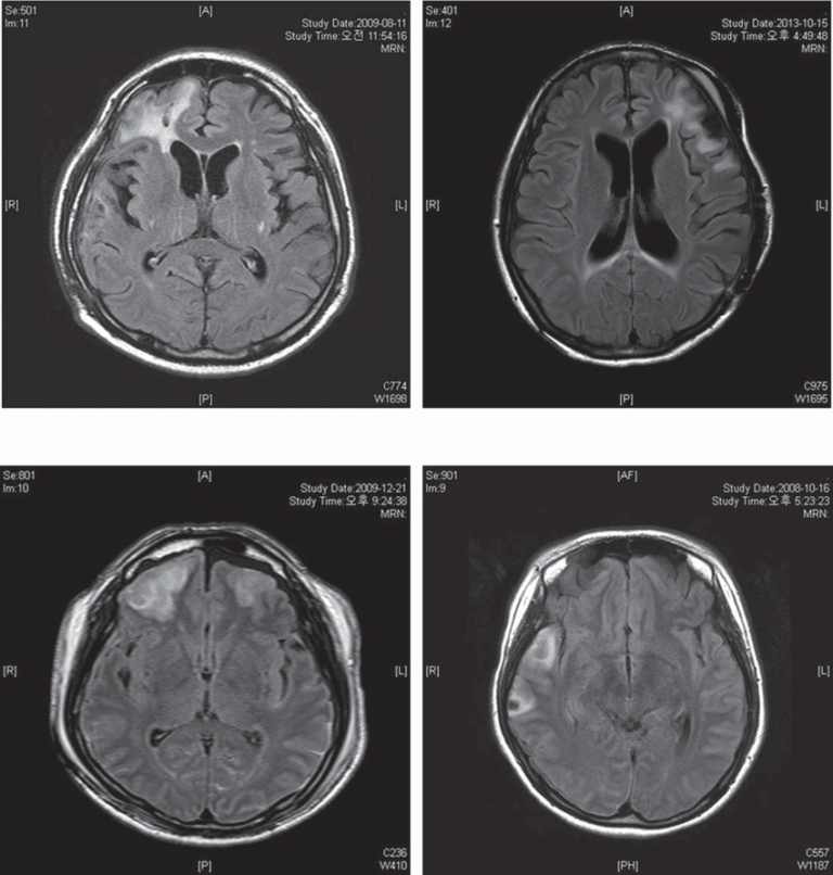 【2024年版】頭部外傷の原因・診断・治療・リハビリテーションまで解説 – STROKE LAB 東京/大阪 自費リハビリ | 脳卒中/神経系
