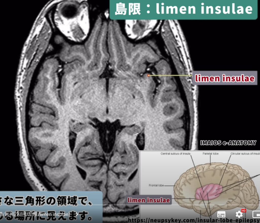 【2025年版】脳の島皮質と感覚統合療法：痛み、疼痛への効果的な評価・リハビリテーションとは？ – STROKE LAB 東京/大阪 自費 ...